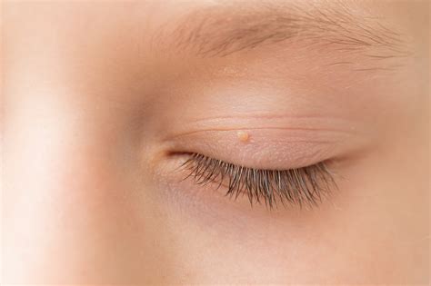 White Bump On Upper Eyelid