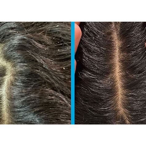 Scalp Scrub Exfoliating Anti Dandruff Treatment Umberto