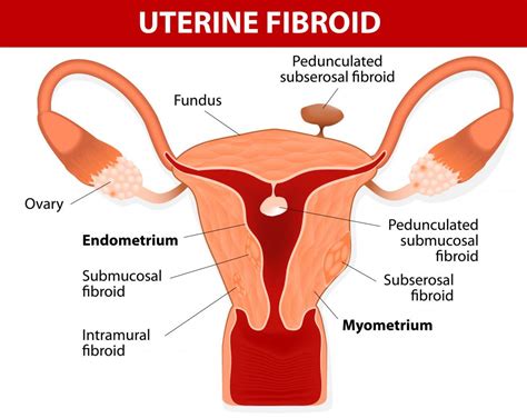 Retroflexed Vs Retroverted Uterus