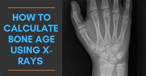 Calculating Bone Age Using X Rays Includes Ai Based Automated Tools