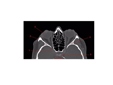 Orbital Calcification Ppt