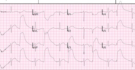 Dr Smiths Ecg Blog Long Qt Syndrome With Continuously Recurrent Polymorphic Vt Management