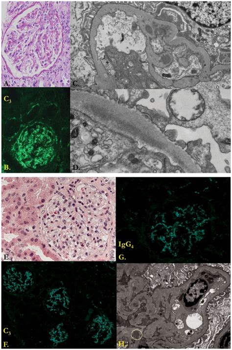 C3 Glomerulonephritis Secondary To Mutations In Factors H And I Rapid Recurrence In Deceased