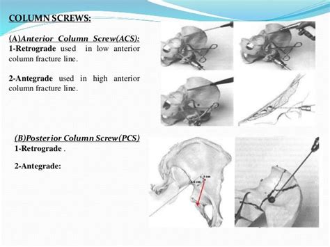 Surgical Treatment Of Associated Patterns Fracture Acetabulum