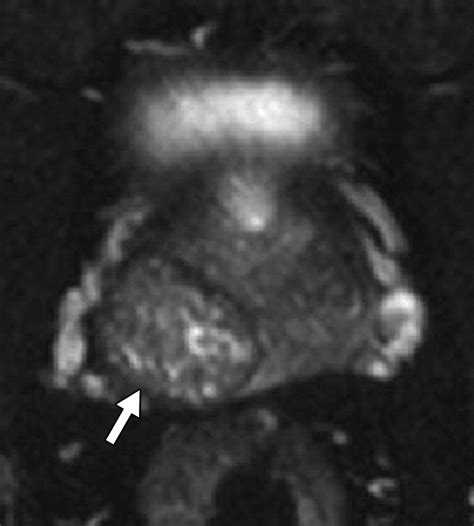 Prostatic Stromal Neoplasms Differential Diagnosis Of Cystic And Solid