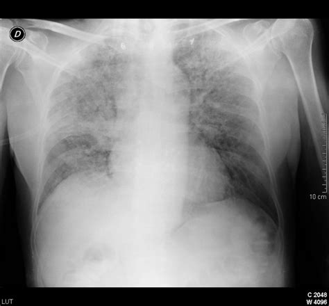 Diffuse Bilateral Interstitial Infiltrates Were Predominant In Upper Diffuse Bilateral Interstitial Infiltrates Were Predominant In Upper
