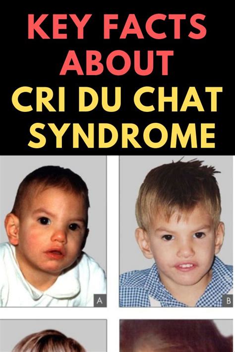 Cri Du Chat Syndrome Interesting Facts Causes Symptoms Treatment