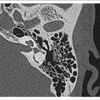 On Coronal Temporal Multidetector Computed Tomography Download Scientific Diagram