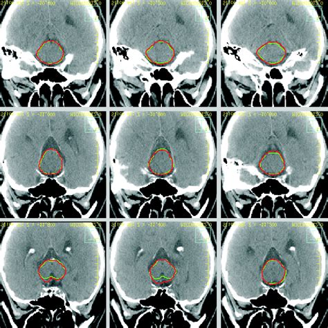 Snapshots Of The Brainstem Segmentation Result For One Test Subject