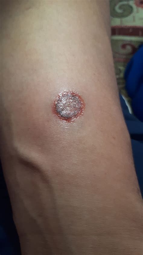 Красное пятно с ободком Вопрос дерматологу 03 Онлайн