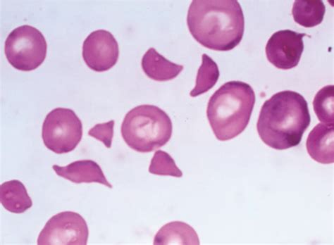 Platelet Diseases Part 1 Flashcards Quizlet