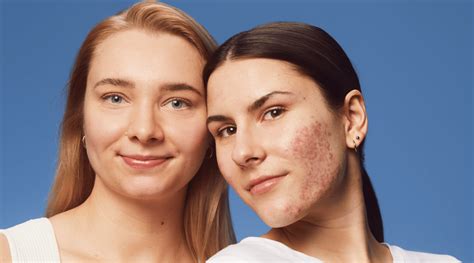 How To Get Rid Of Breakouts Causes And Remedies Nivea