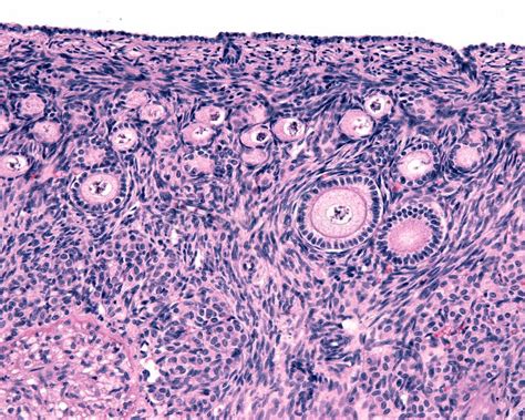 Stroma Ovary