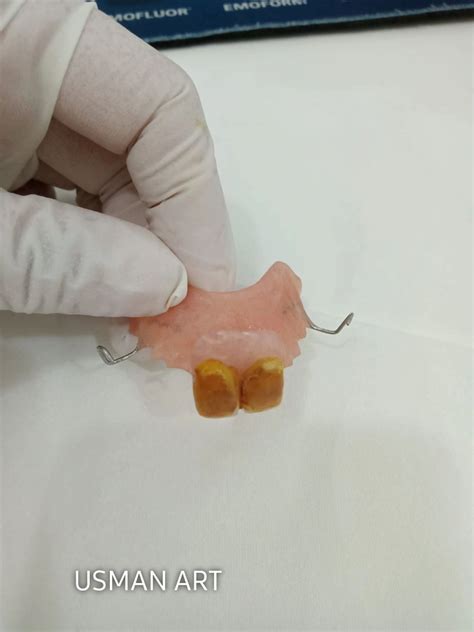 Muhammad Usman Abbasi On Linkedin Patient Want This Shade 😎 This Is Not Just Make Denture