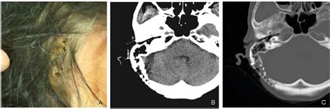 Figure 2 From Exposure Of Titanium Mesh After Cranioplasty For Microvascular Decompression