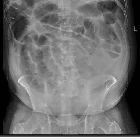 Abdominal X Ray Showed Diffuse Ileus Download Scientific Diagram