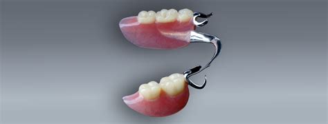 Removable Cast Partial Dentures South Calgary Denture And Implant Clinic