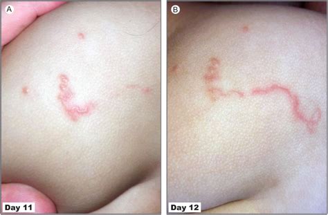 Cutaneous Larva Migrans