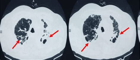 Clinical Radiological And Lung Function Characteristics Of Post Tuberculosis Bronchiectasis