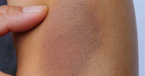 Bruise Colors Stages Causes And When To Contact A Doctor