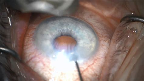 Istent Surgical Procedure For Glaucoma Brian Morgan Md Youtube