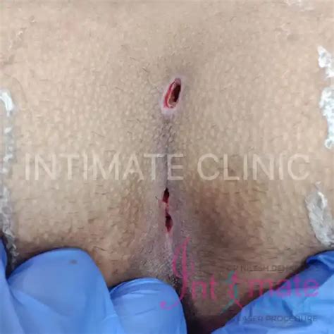 Excision Of Pilonidal Sinus And Ablation Intimate Clinic
