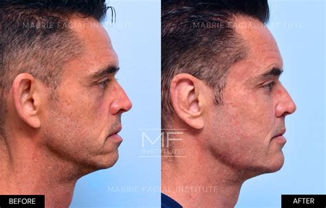 Chin And Jawline Fillers And Botox A Guide To Facial Contouring For