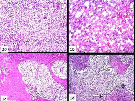 A Massive Proliferation Of Roundish Small Mononuclear Cells B Download Scientific Diagram