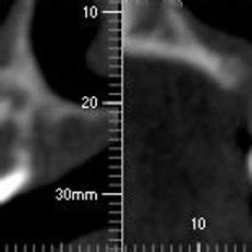 Thick Maxillary Sinus Membrane And Communication Between Maxillary