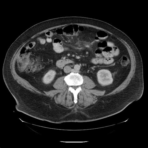 File Jejunal Diverticulitis With Migration Of A Large Obstructing
