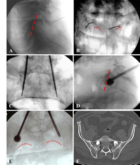 Sacroplasty Using Fluoroscopic Guidance Lateral View Marking Of The
