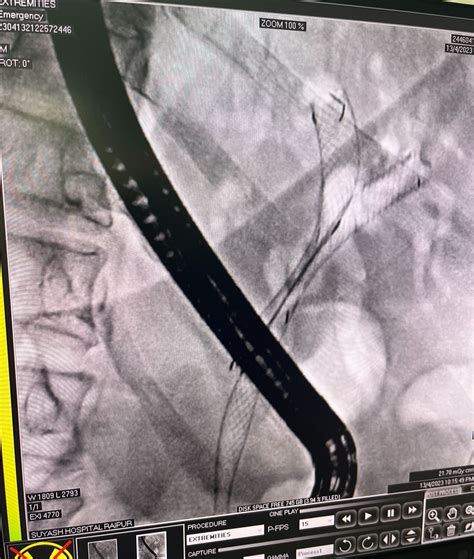 Dr Amit Joshi On Linkedin One Of The Most Challenging Ercp Is Management Of Malignant Hilar…