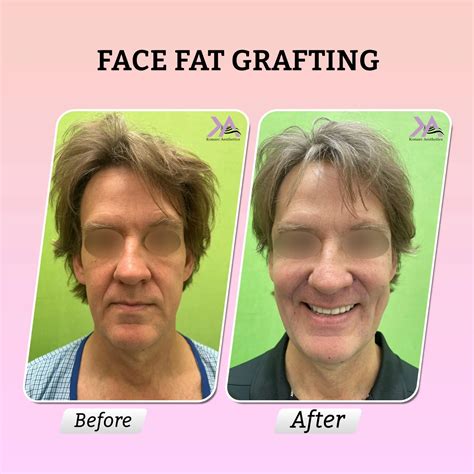 Facial Fat Grafting In Gurgaon Face Fat Injections Cost