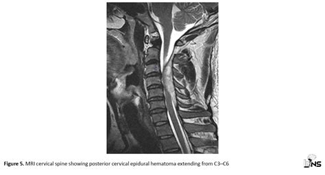 Spinal Epidural Hematoma