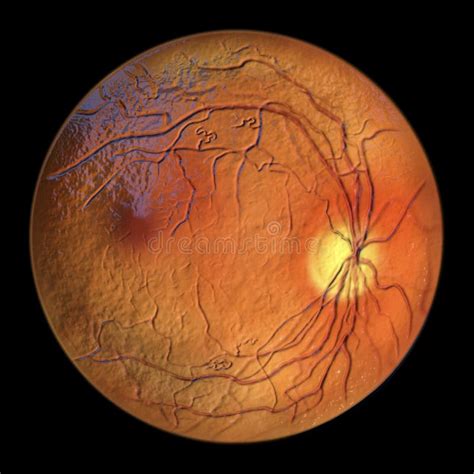 Non Proliferative Diabetic Retinopathy Illustration Showing Irmas