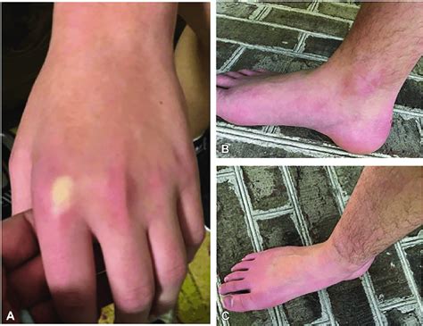 Blanching Erythema Overlying The Dorsal Surface Of The Hands And Feet