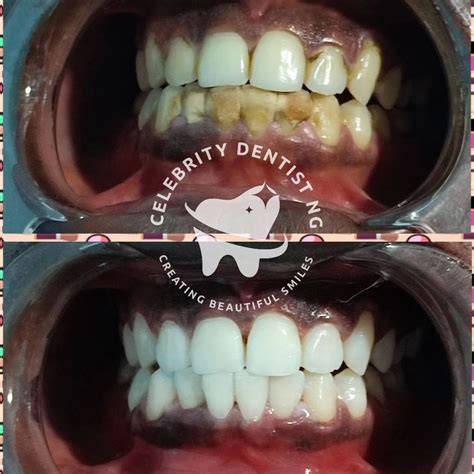Scaling Polishing Vs Teeth Whitening Understanding The Differences