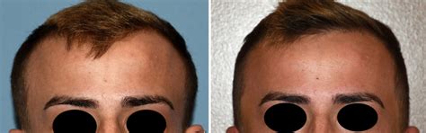 Technical Strategies The Importance Of Deep Fascial Closure In Temporal Reduction For Head