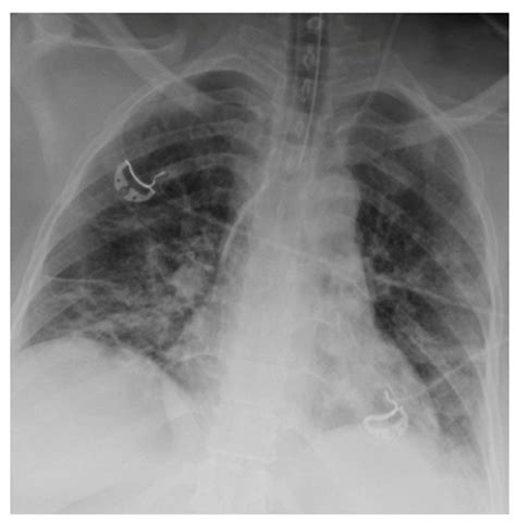 Diffuse Bilateral—hazy Infiltrates Throughout Both Lungs Download Scientific Diagram