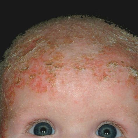Seborrheic Dermatitis Scalp Infant