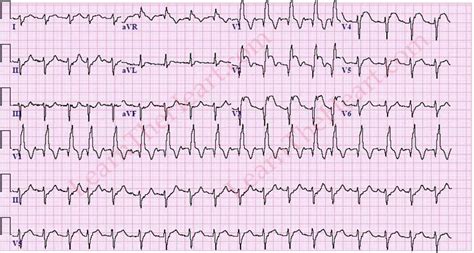 Anterior St Elevation Myocardial Infarction Mi With Rbbb Ecg My Xxx