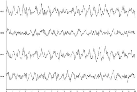 Pattern Of Polyspike Ps Type Eeg Recording Eeg 1 Fp1 Left Mastoid