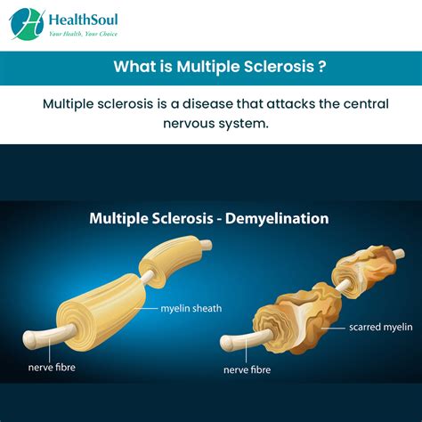 Multiple Sclerosis
