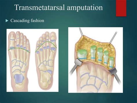 Amputations Of Lower Limbs Autosaved Copypptx
