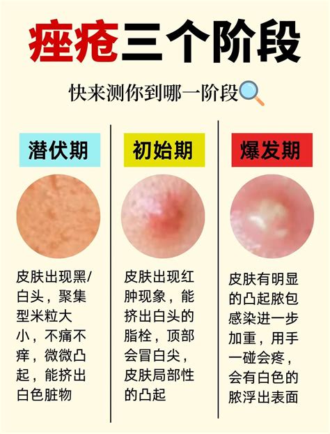 🔍痤疮的四大常见类型及护理指南