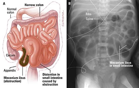 Meconium Ileus Causes Symptoms Diagnosis Treatment And Prognosis