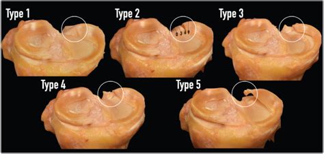 Diagnosis And Treatment Strategies Of Meniscus Root Tears A Scoping