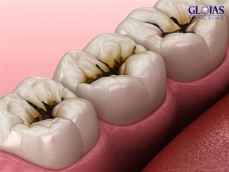 Tooth Cavities Causes Prevention And Treatment Options