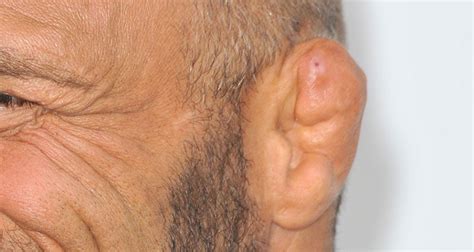 Rugby Injuries Ear Prevalence Of Cauliflower Ear In High Level Judoka