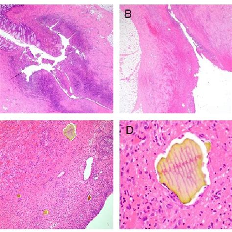 A Diverticulitis Showing Abscess Formation And Bowel Perforation Download Scientific Diagram
